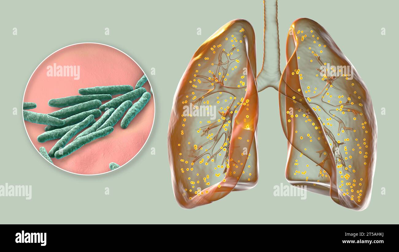 Lungs affected by miliary tuberculosis, illustration Stock Photo - Alamy