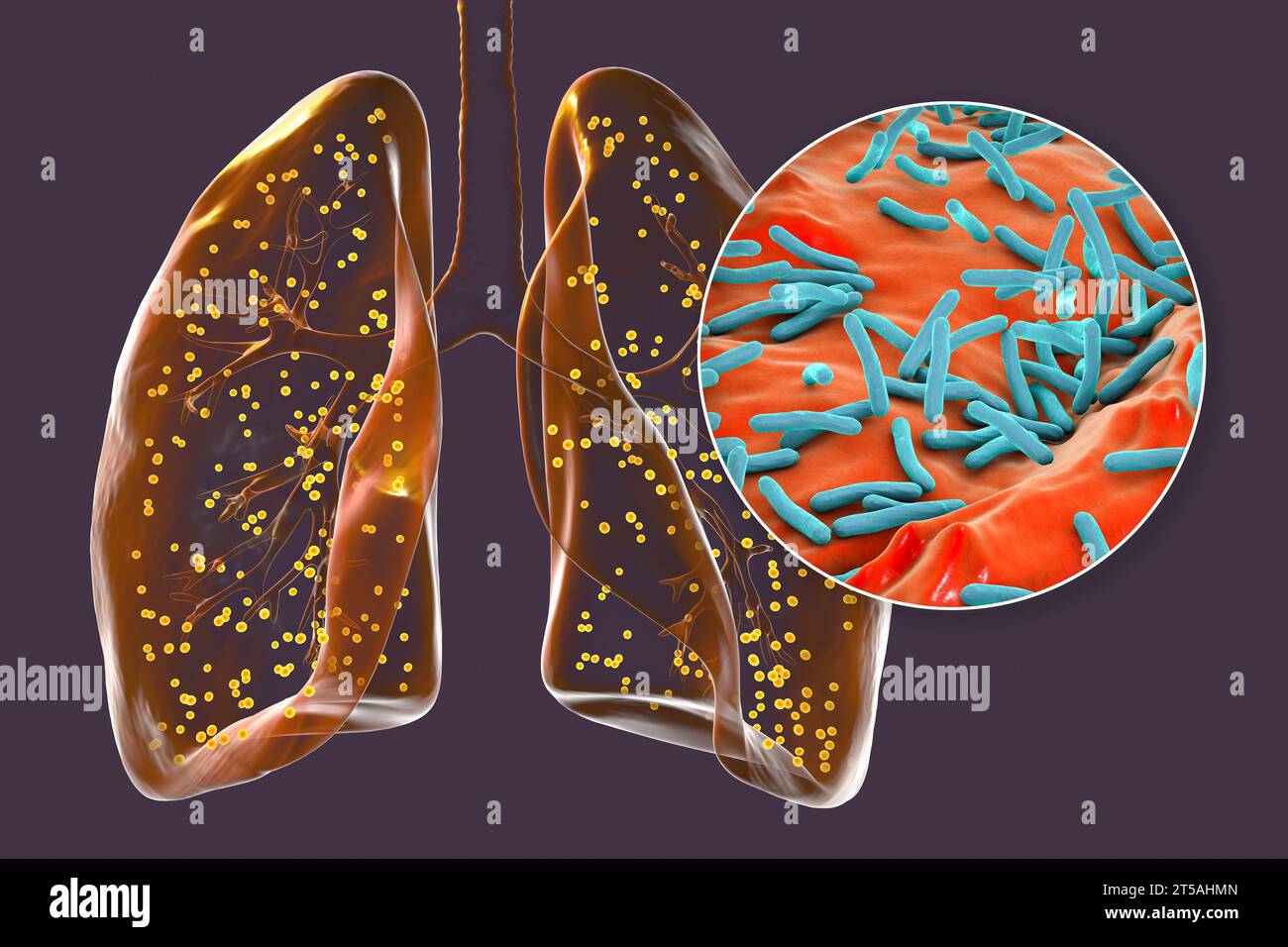 Lungs affected by miliary tuberculosis, illustration Stock Photo - Alamy
