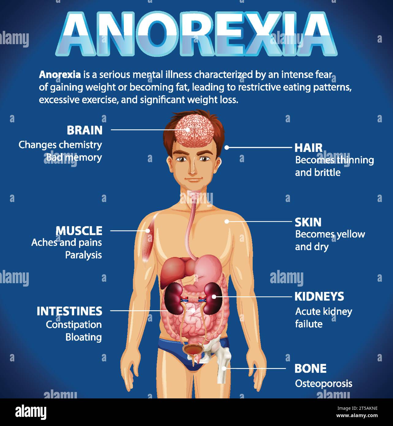 Illustration depicting the impact of Anorexia on various body functions ...