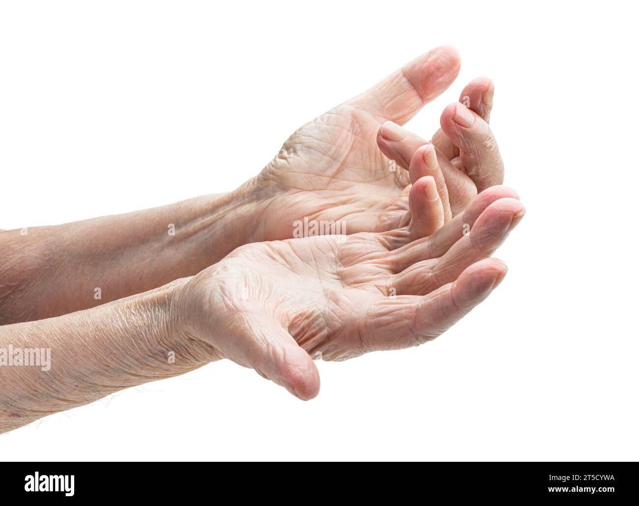 Hands of an old woman with Dupuytren's contracture disease Stock Photo ...