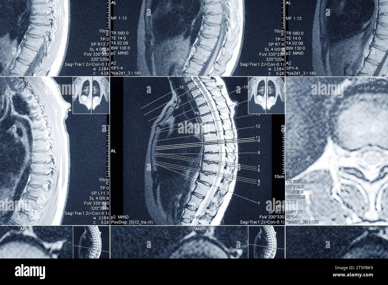 MRI scan of the thoracic spine for diagnosis. Medical examination for ...