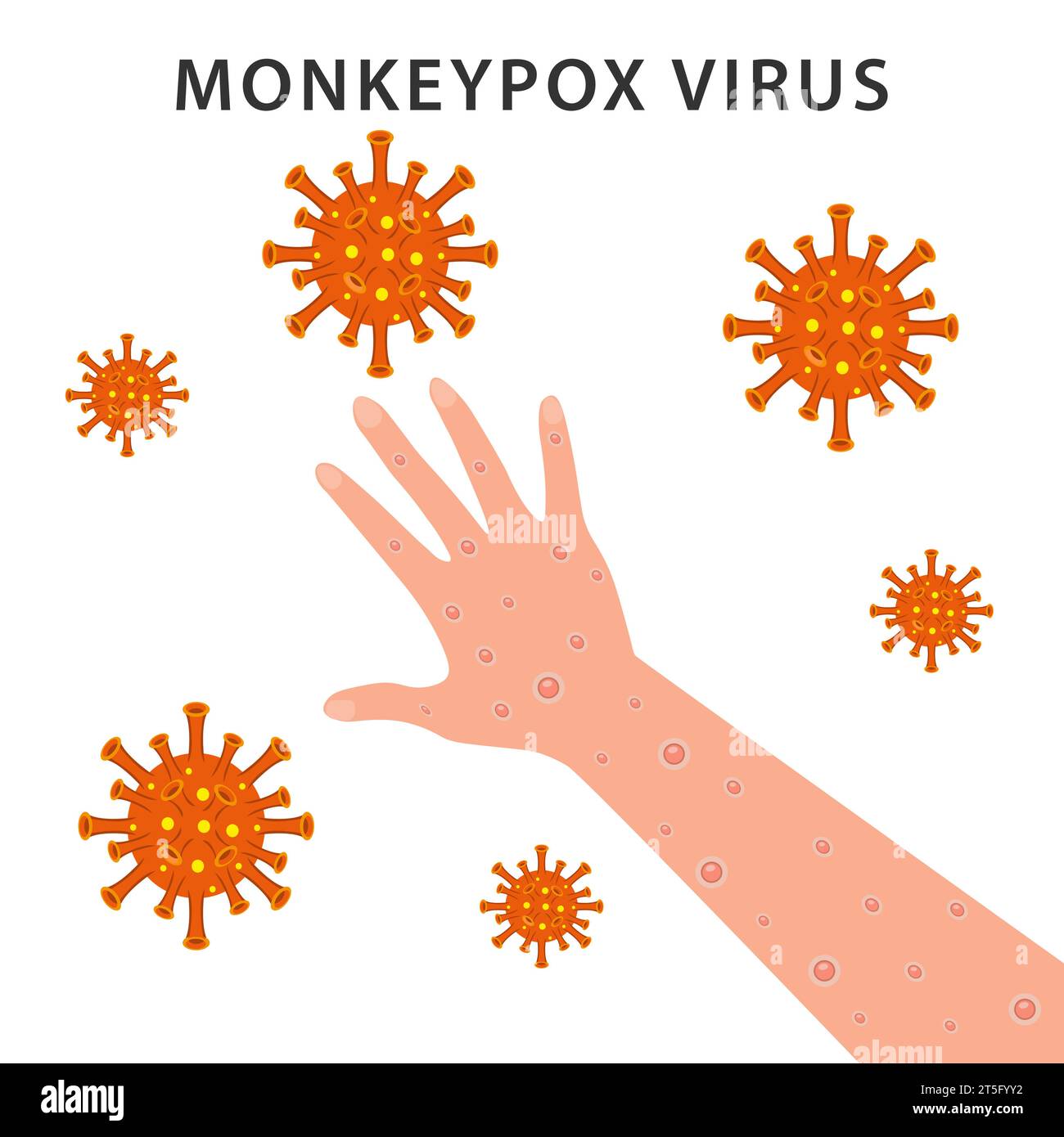Monkeypox virus zoonotic viral disease that can infect human, nonhuman ...
