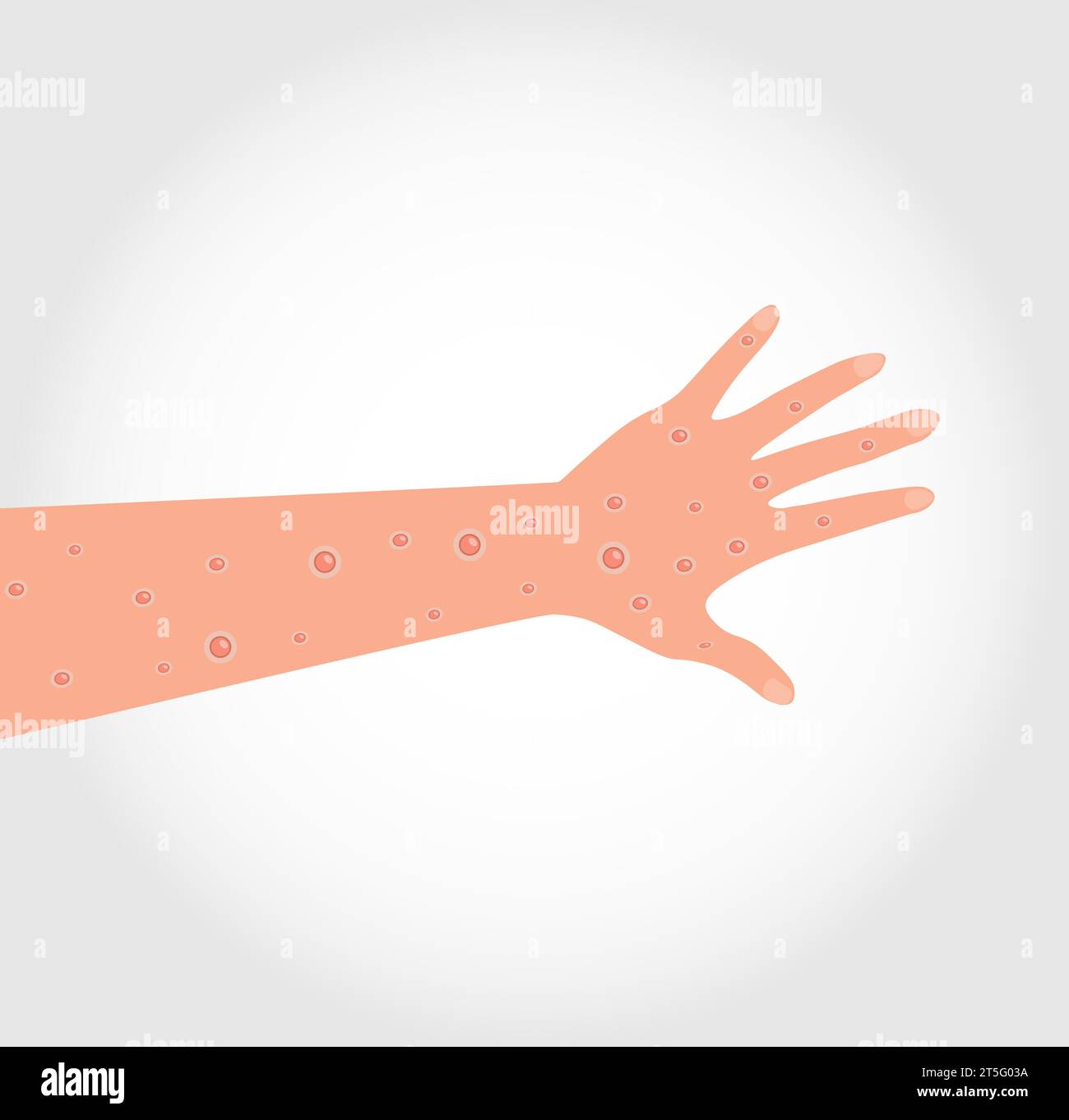 Pox on hand hi-res stock photography and images - Alamy