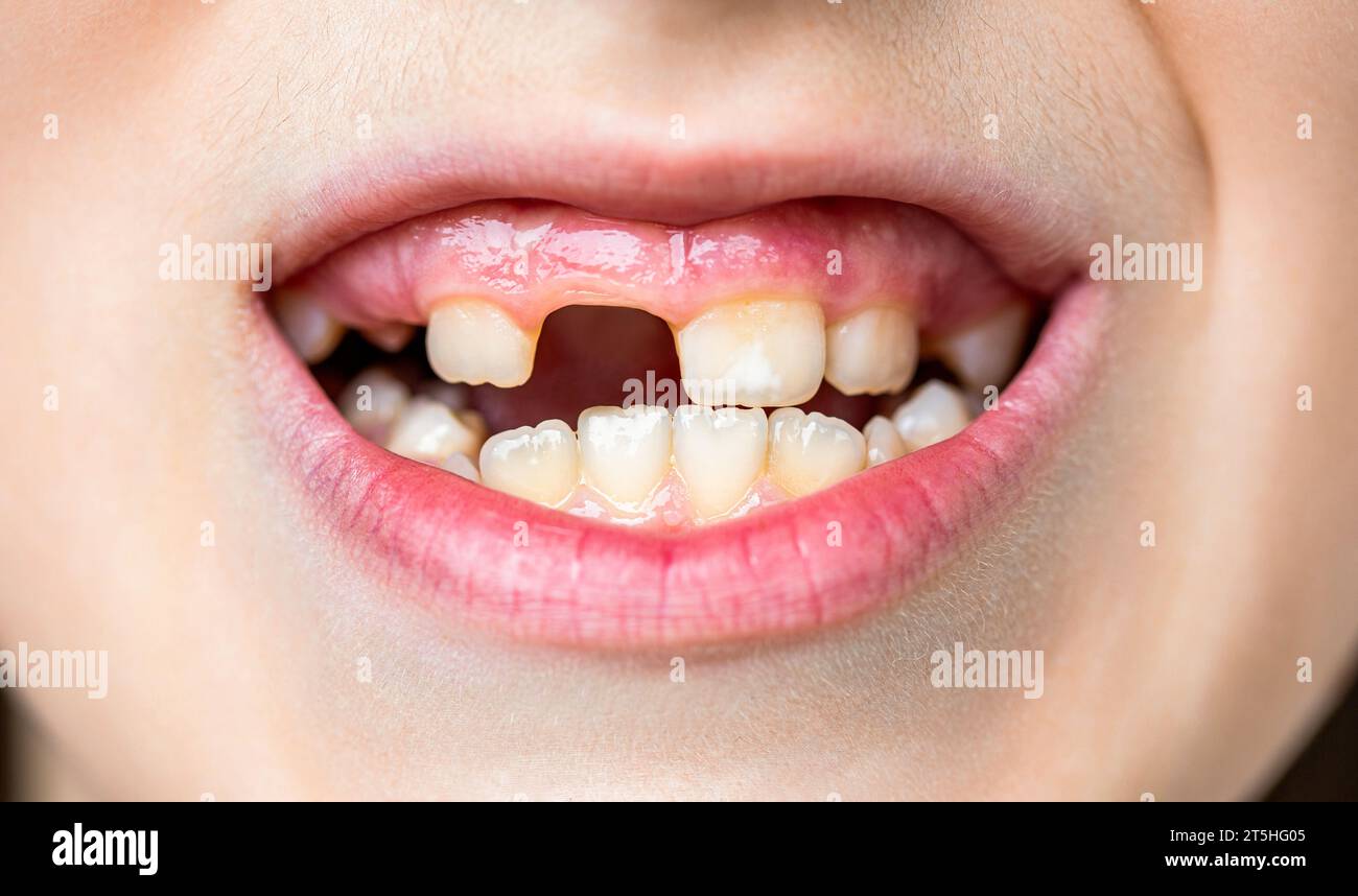 Child bad teeth. Boy kid lost front tooth, toothache. Child without one ...