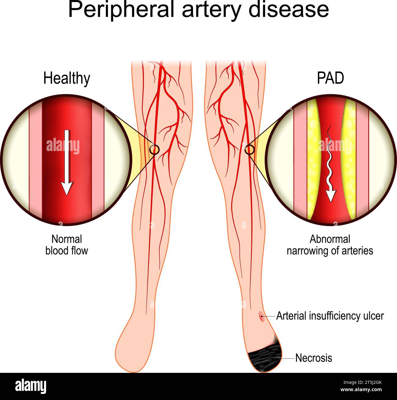 Peripheral Vascular Disease Stock Vector Images Alamy