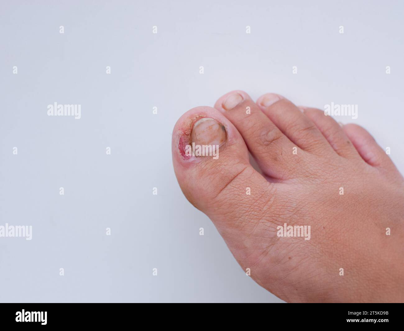 close up of ingrown toenail is Inflamed fingernails isolated on white ...