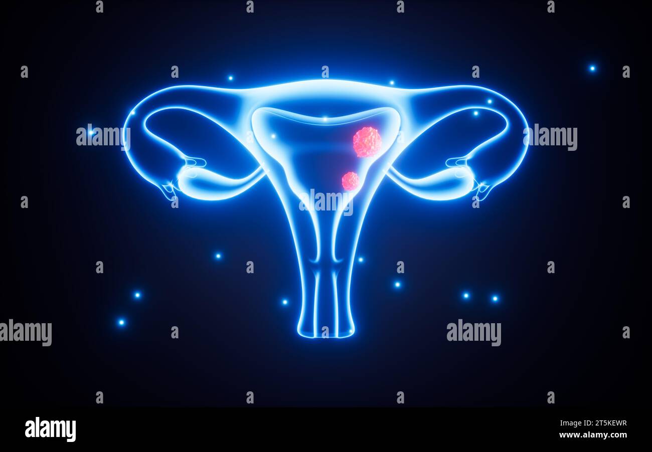 Uterine cancer , gynecological disease, medical concept, 3d rendering ...