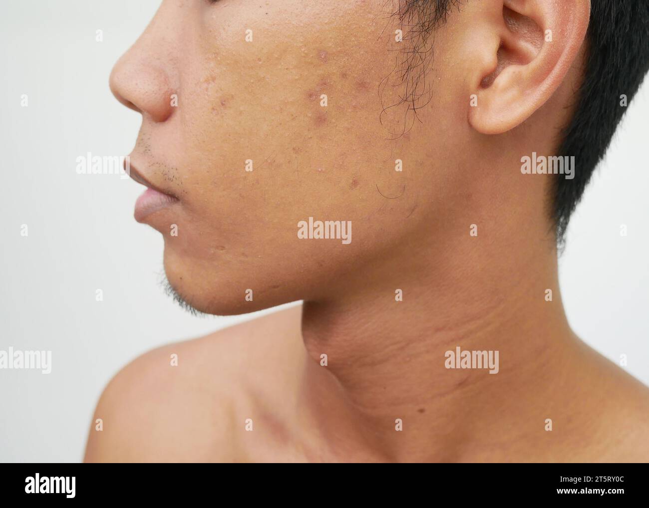 Close-up of Asian man's face with skin problems and acne scars Stock ...