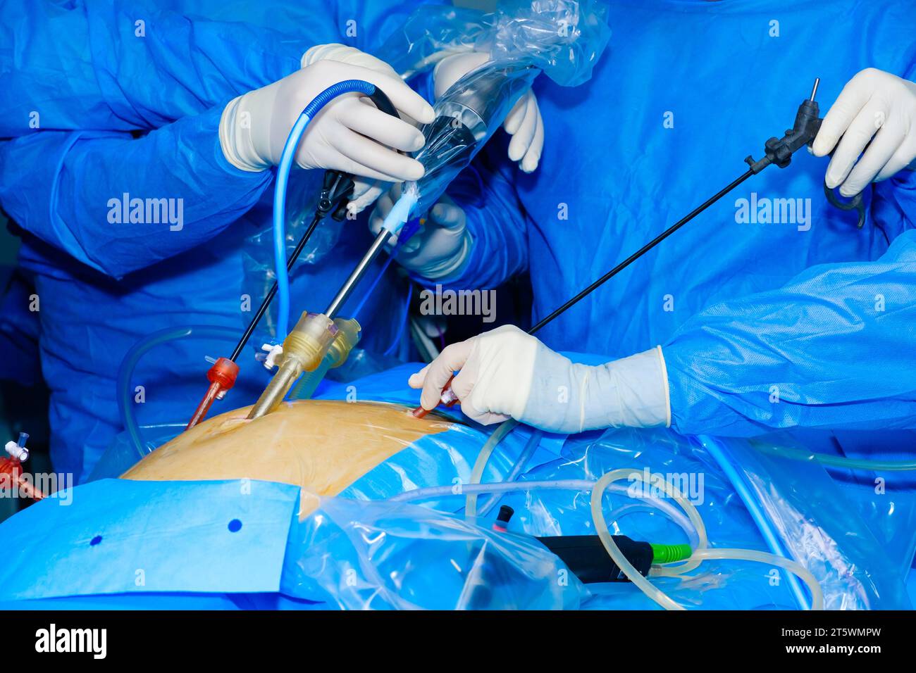 A team of doctors operates on a patient through punctures in the ...