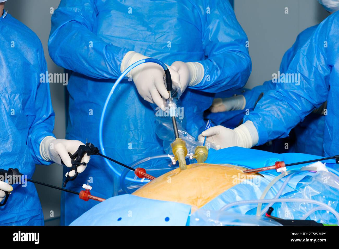 Doctors remove a cancerous tumor in a patient's intestine using ...