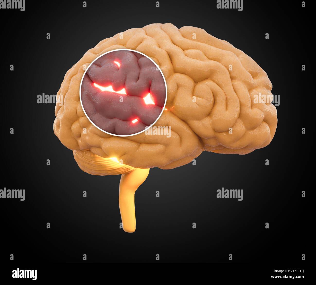 Memory lapses, forgetting things, degenerative disease. Brain problems ...