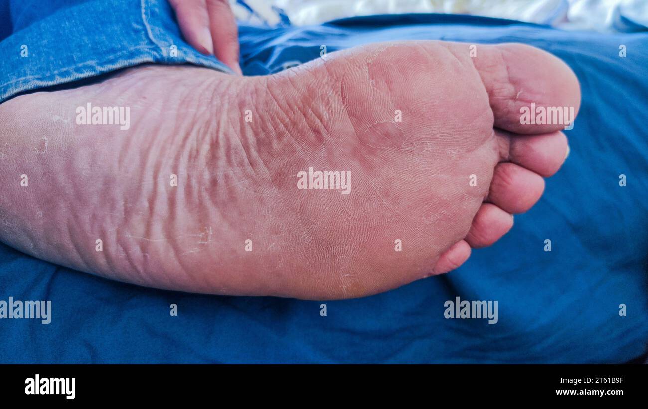 detail of a sore and dry foot awaiting medical treatment from a ...