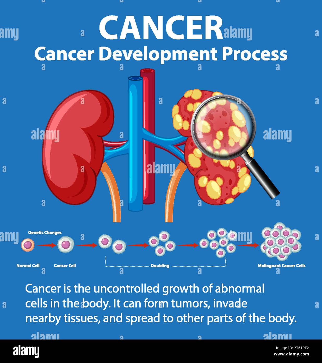 Illustrated infographic depicting the process of cancer development on ...