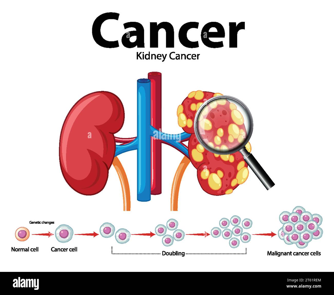 Illustration depicting the abnormal cell growth and progression of ...