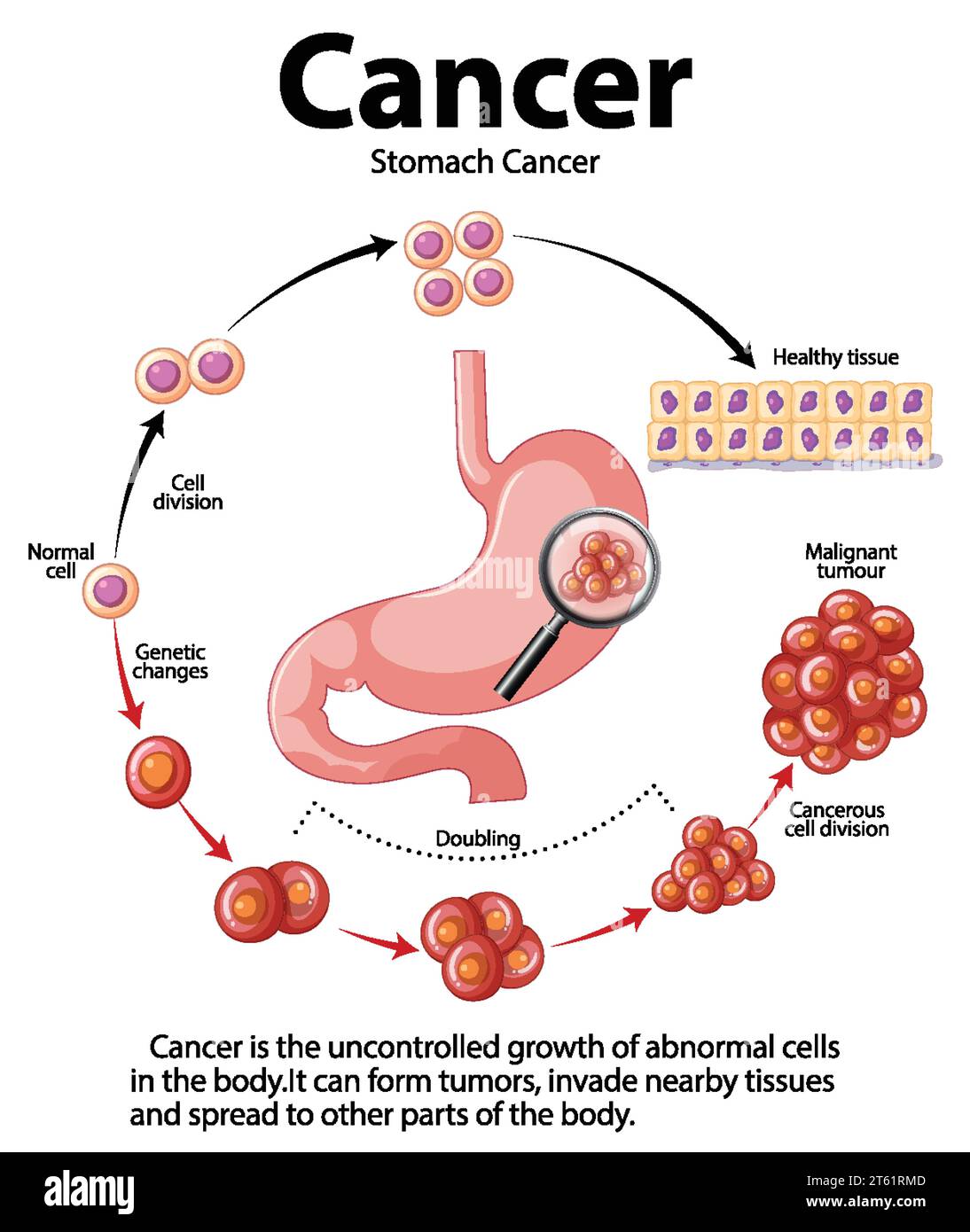 Illustrated infographic depicting abnormal cell growth in stomach ...