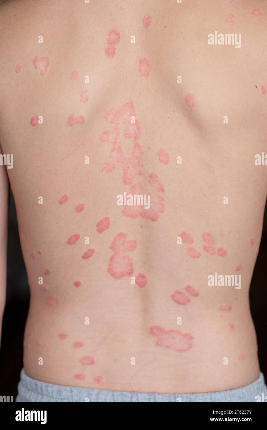 Psoriasis Vulgaris, skin patches are typically red, itchy, and scaly ...