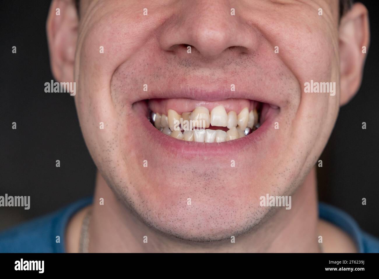 A man's crooked teeth. Young man showing crooked growing teeth Stock ...
