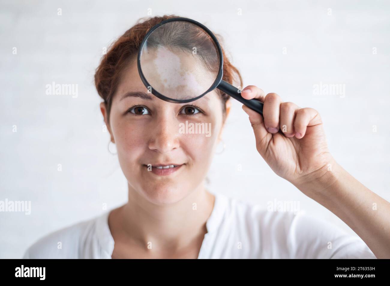Vitiligo. Portrait of a beautiful woman with lack of skin pigmentation ...