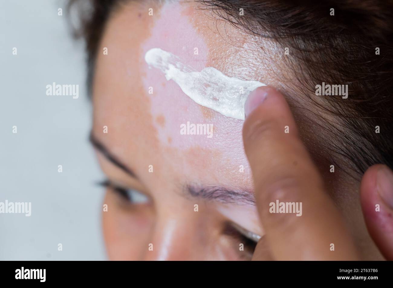 Vitiligo. A close-up portrait of a woman with no skin pigmentation on ...