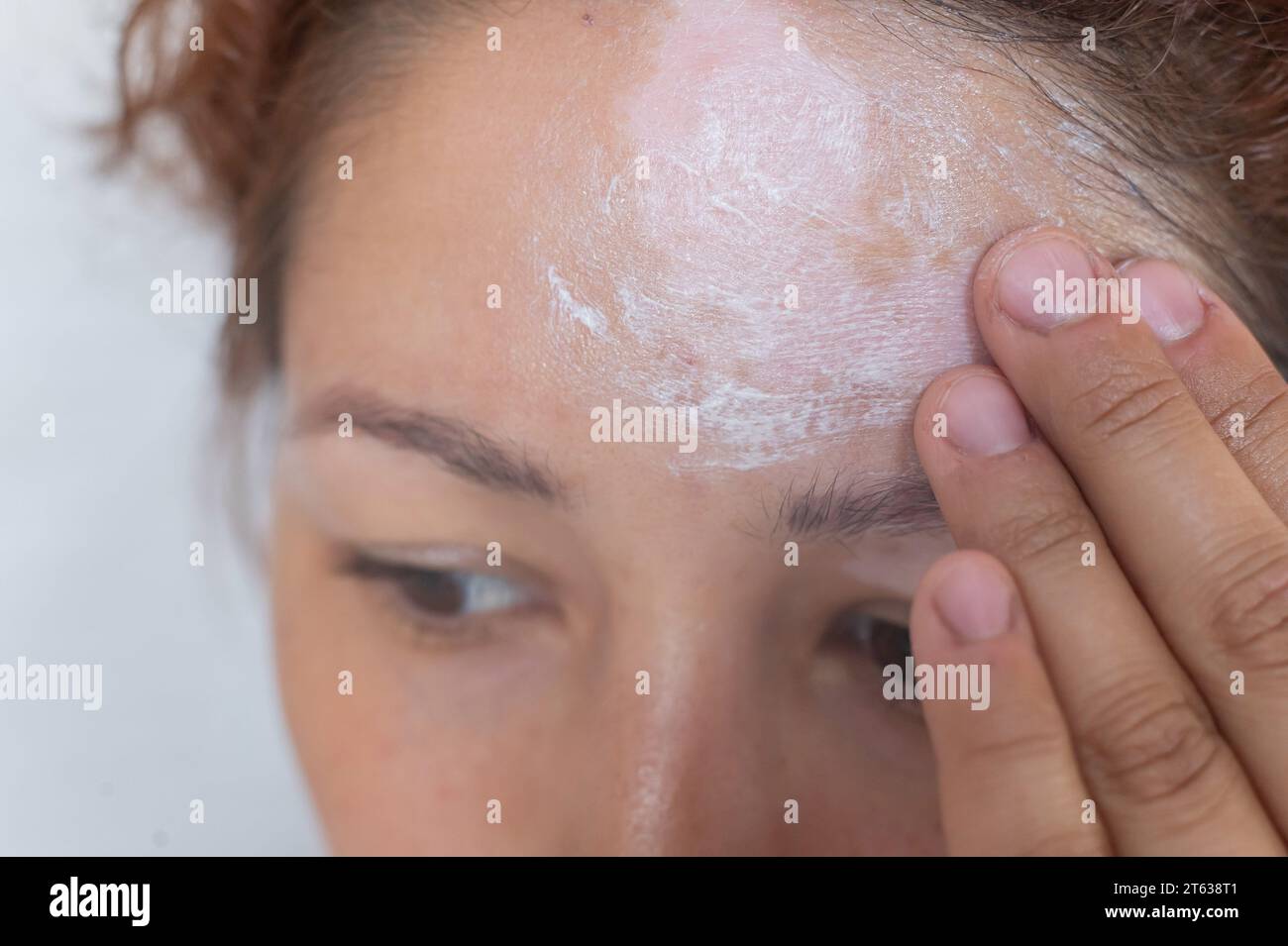 Vitiligo. A close-up portrait of a woman with no skin pigmentation on ...