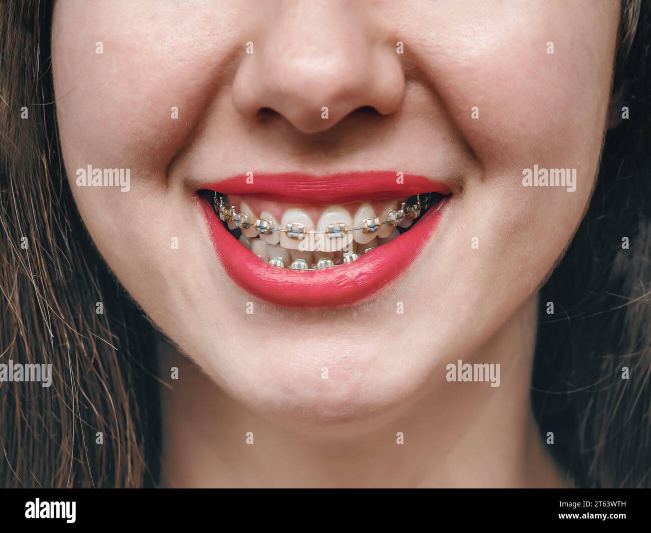 Orthodontic Treatment. Dental Care Concept. Beautiful Woman Healthy ...