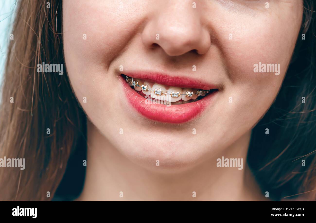 Orthodontic Treatment. Dental Care Concept. Beautiful Woman Healthy ...