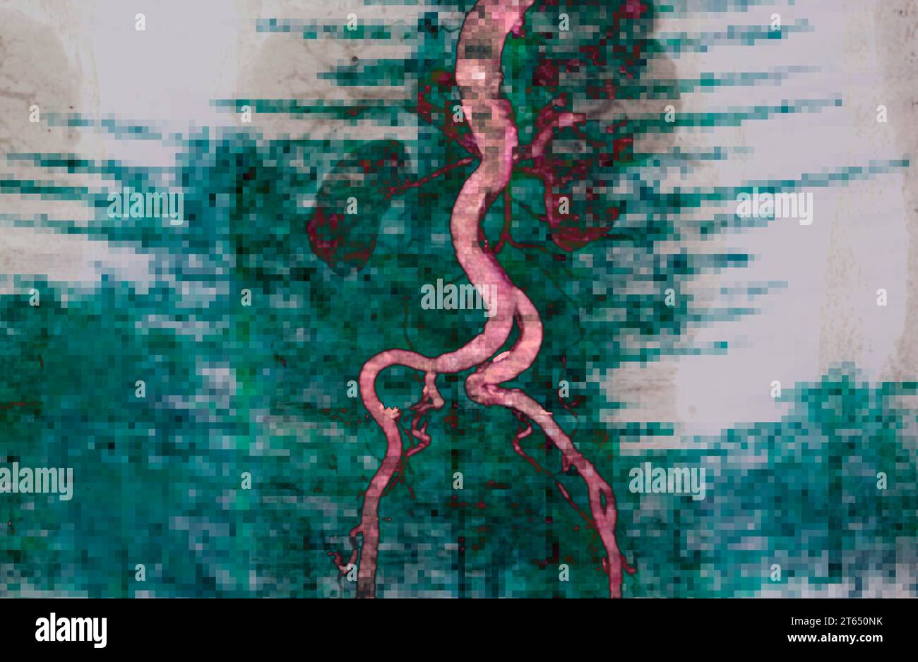 Illustration of a human abdominal aorta Stock Photo - Alamy