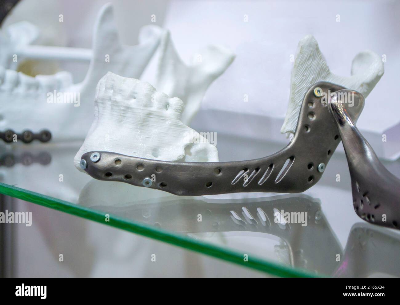 Facial bone of lower human jaw individual prosthesis printed on 3D ...