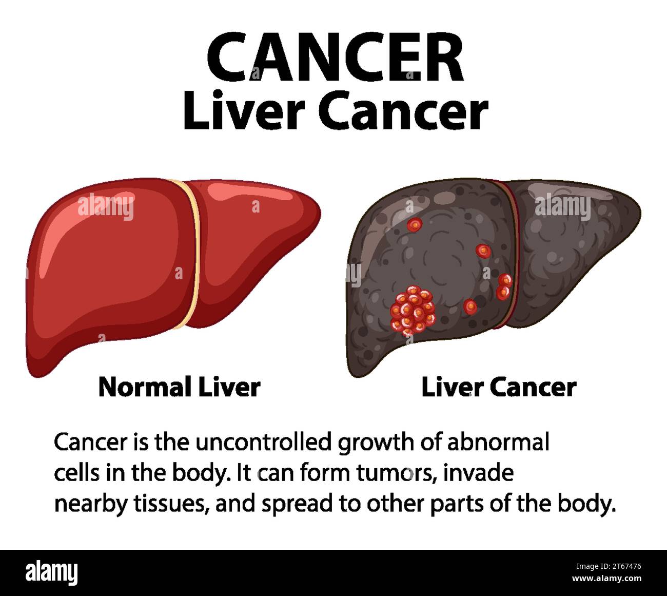 Infographic illustrating the differences between healthy and cancerous liver cells Stock Vector ...