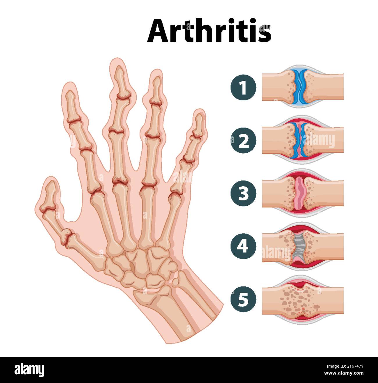 Illustrated infographic depicting the stages of arthritis in the human ...