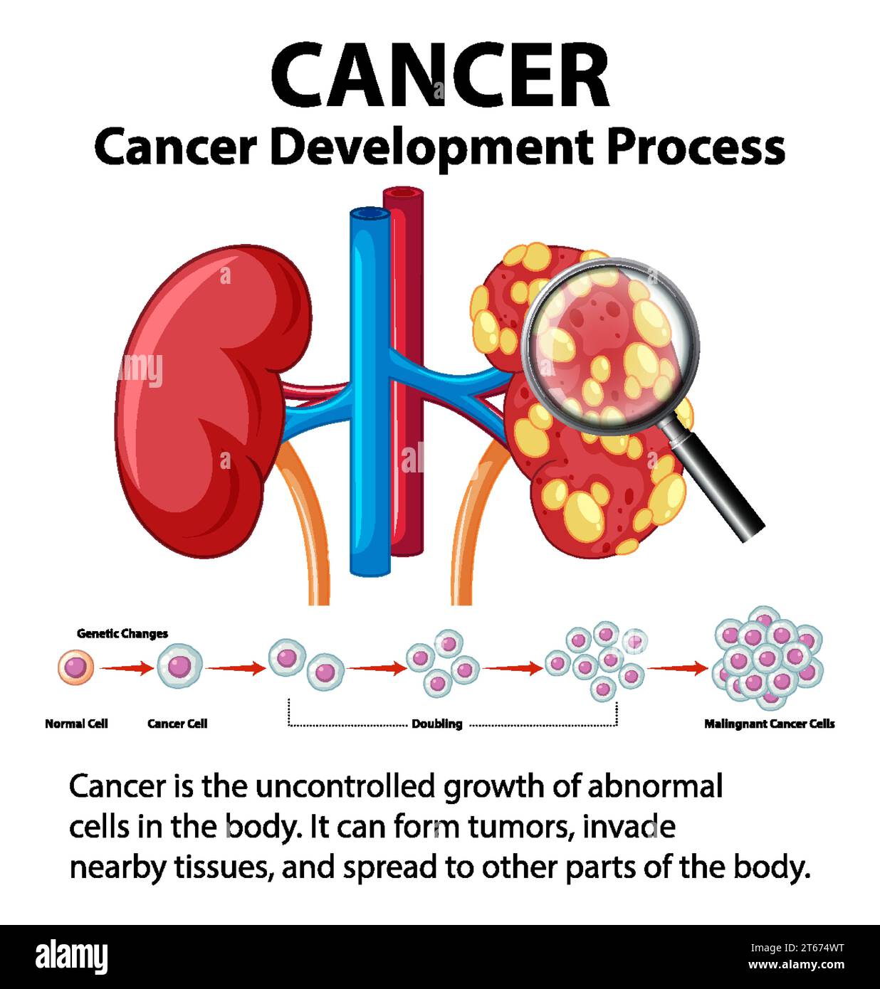 Illustrated infographic depicting the process of cancer development in ...