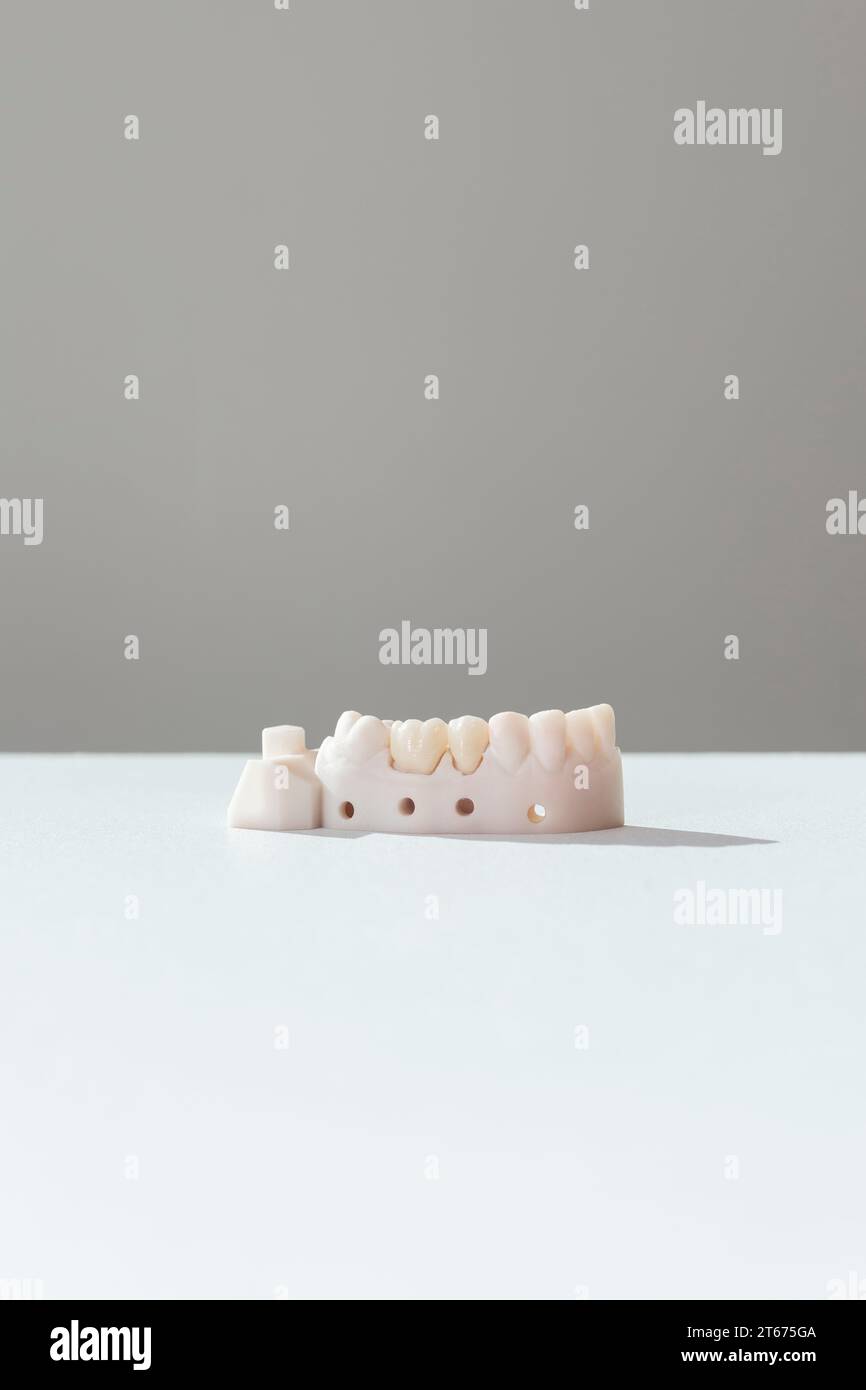 Template Dental Cap Or Tooth Crown on Implant Model Tooth Support ...