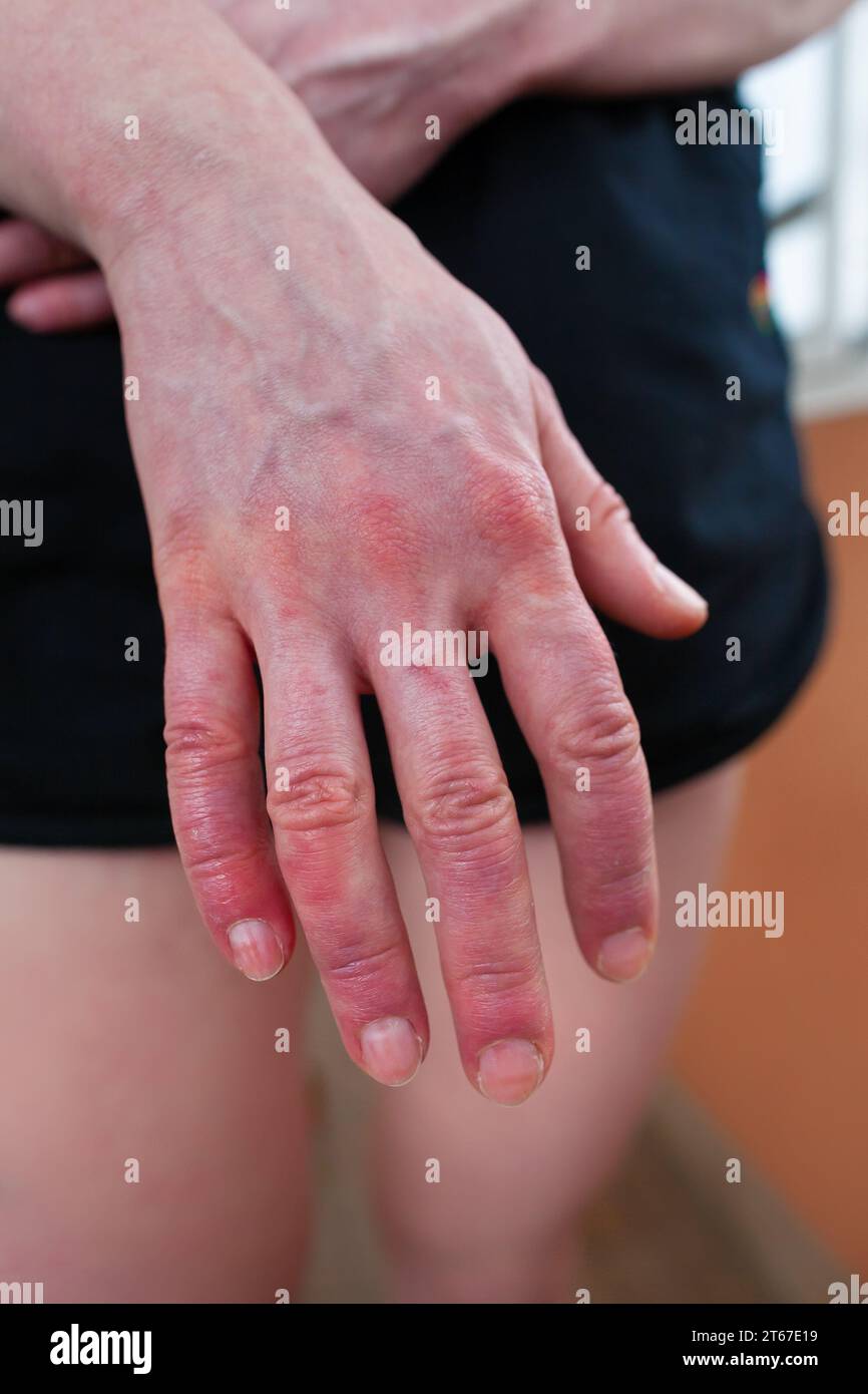Erythromelalgia flare up hi-res stock photography and images - Alamy