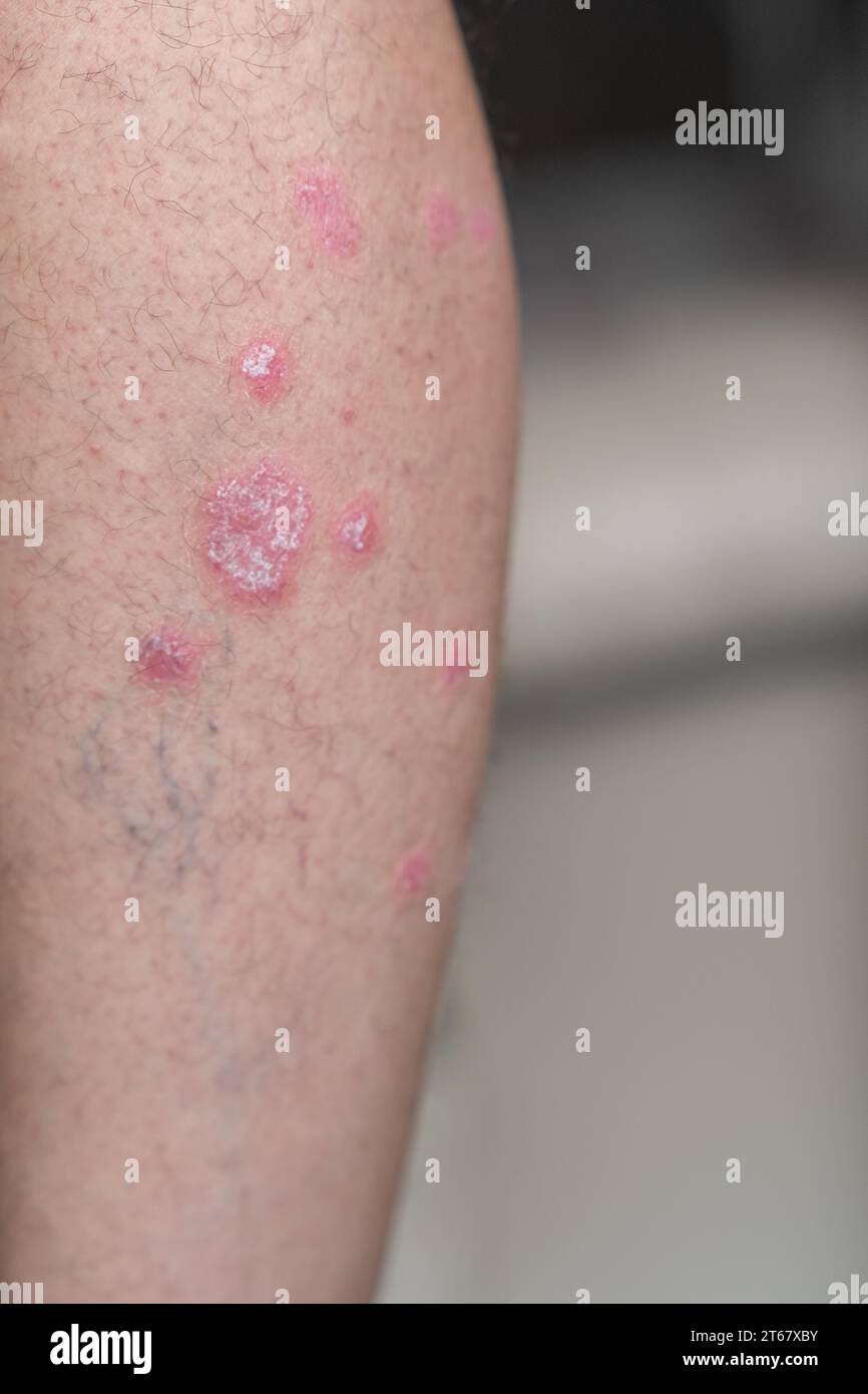 Red scaly patches hi-res stock photography and images - Alamy