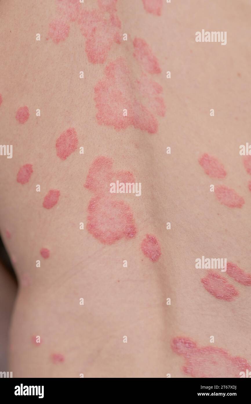 Psoriasis Vulgaris, skin patches are typically red, itchy, and scaly ...