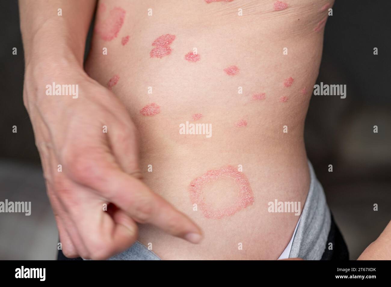 Psoriasis Vulgaris, skin patches are typically red, itchy, and scaly ...