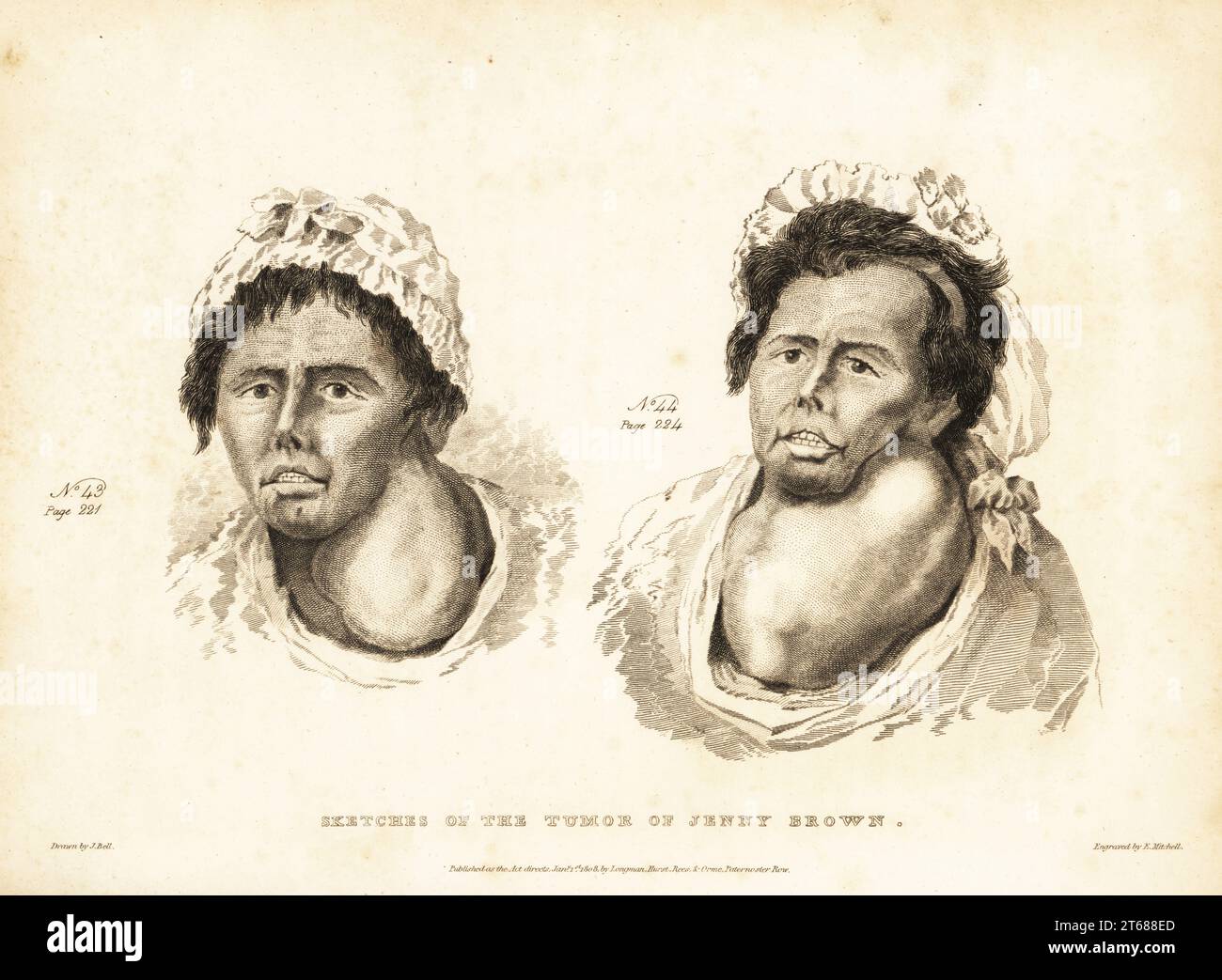 Growth of a neck tumor or "wen" of a poor farm labourer and out servant ...