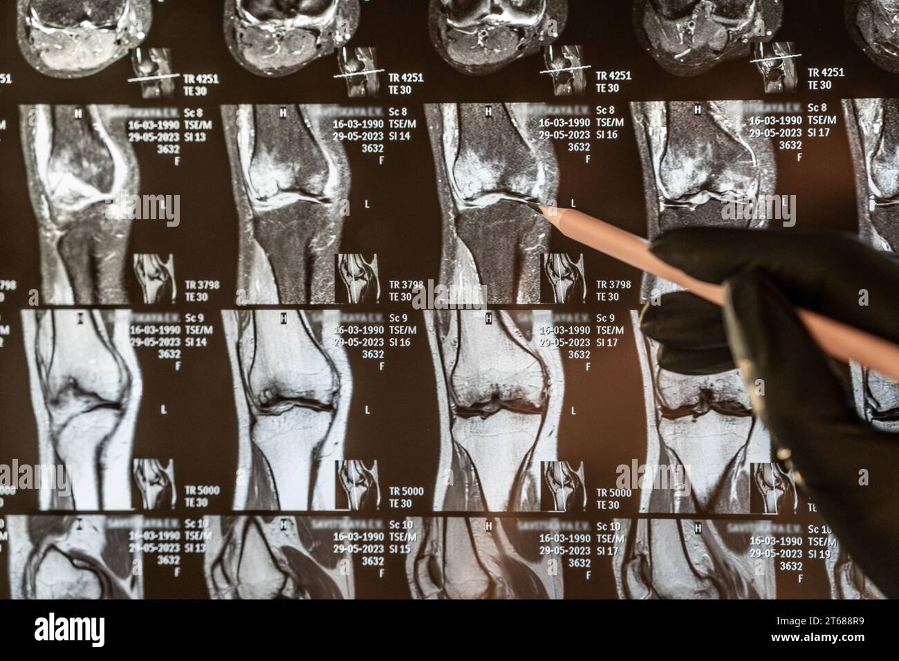 Magnetic resonance imaging of human knee joint for medical diagnosis ...