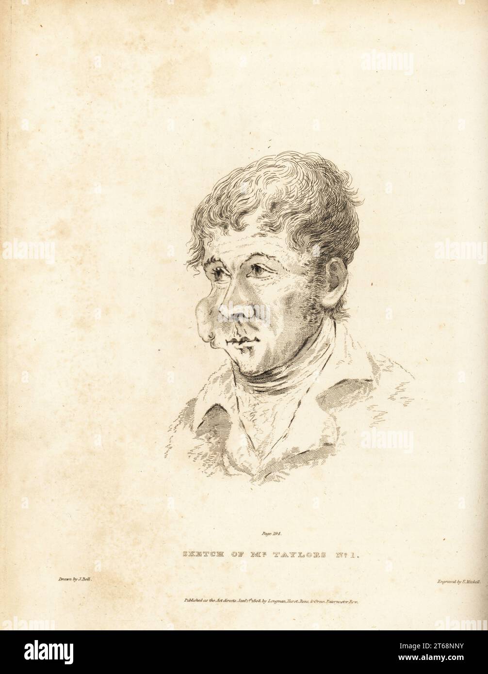 Facial tumor in the cheek of Mr Taylor, a 30-year-old Irish man from ...