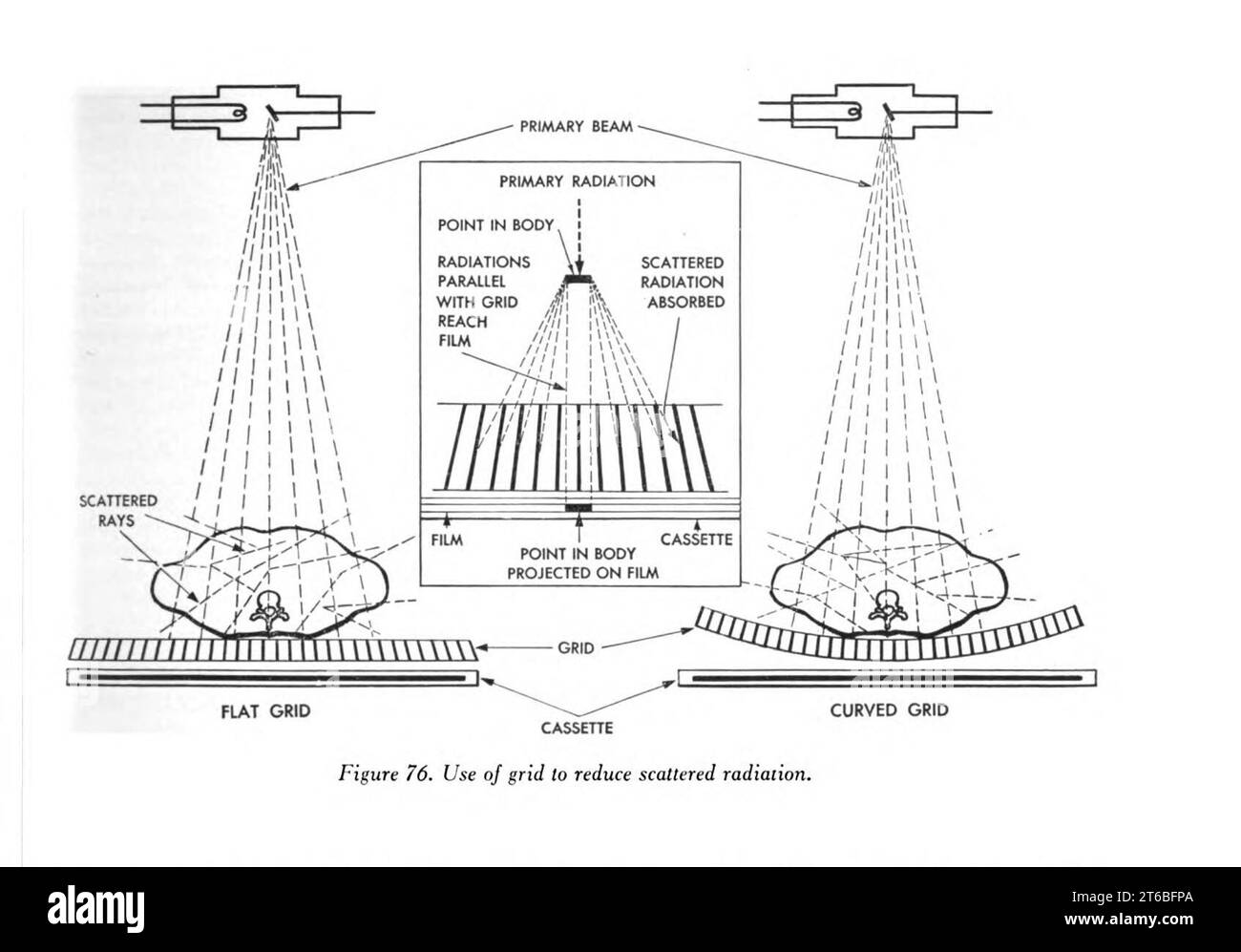 Use of grid to reduce scattered radiation, extracted from Military ...