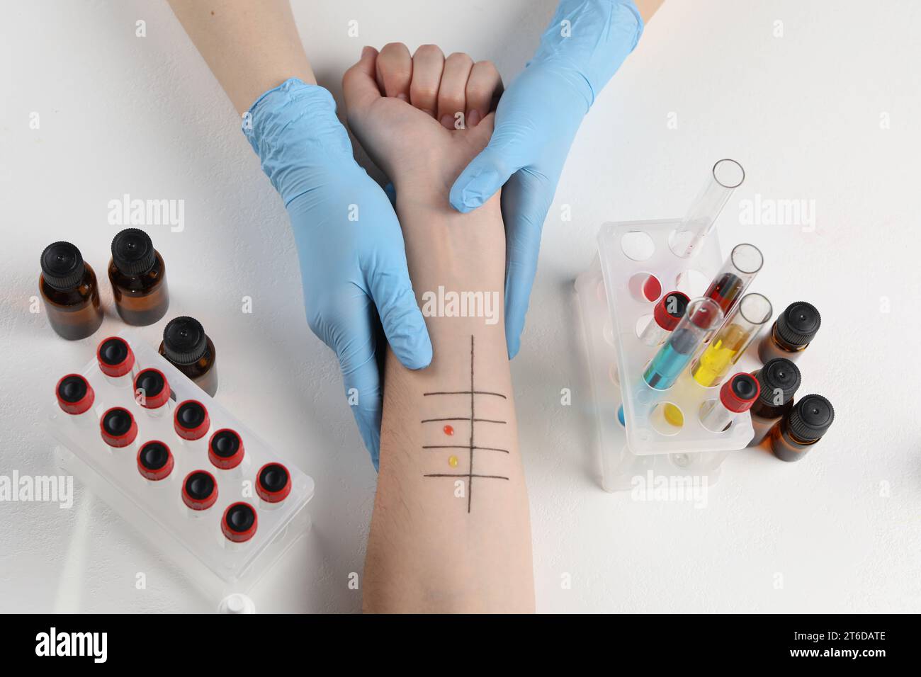 Patient undergoing skin allergy test at light table in clinic, top view ...
