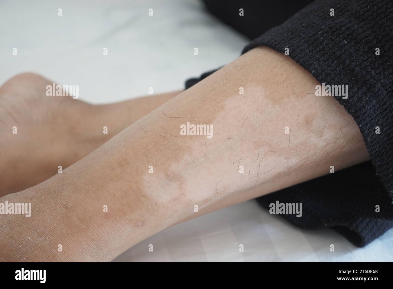 feet with vitiligo skin condition Stock Photo - Alamy