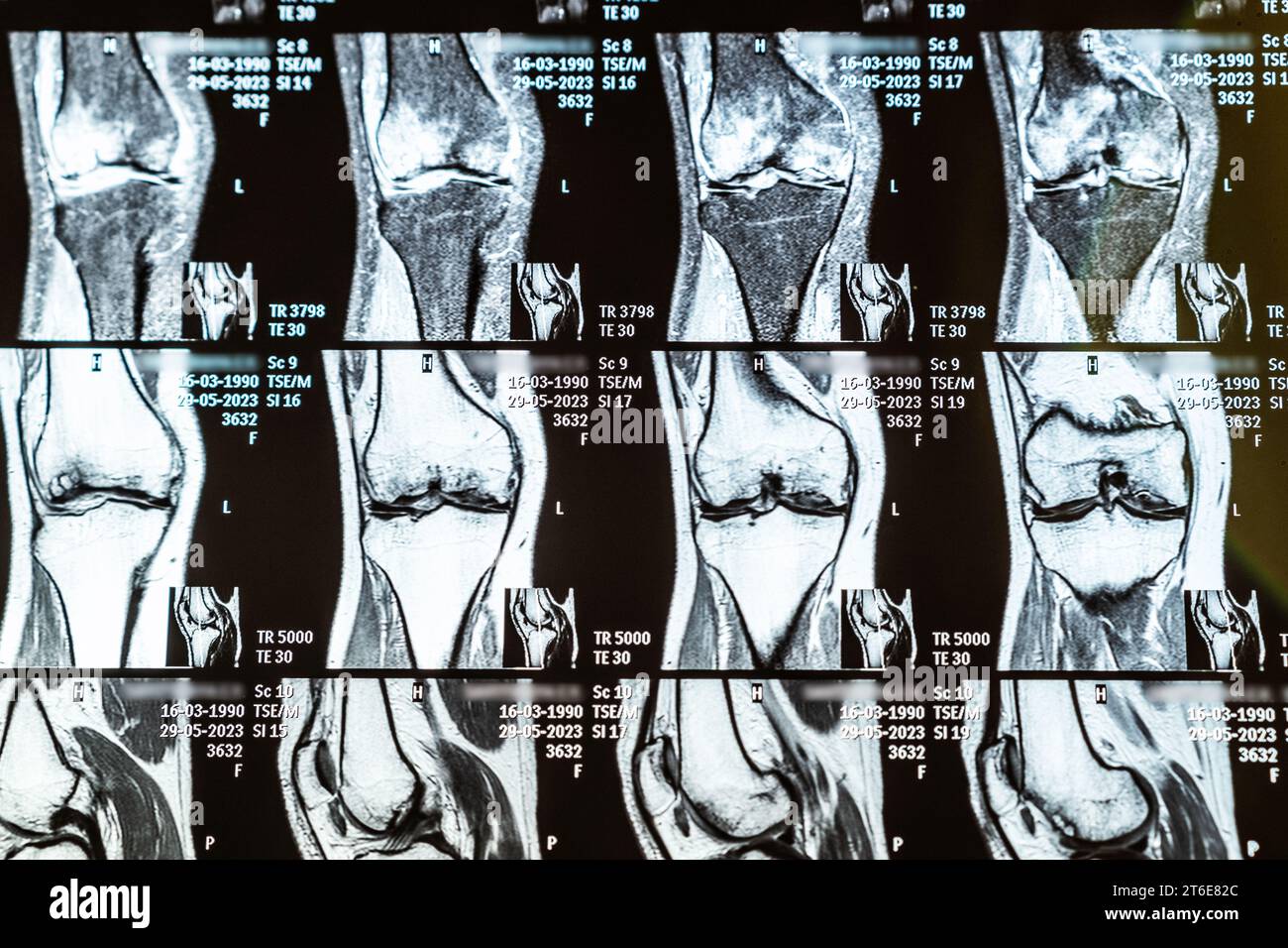 Magnetic resonance imaging of human knee joint for medical diagnosis ...