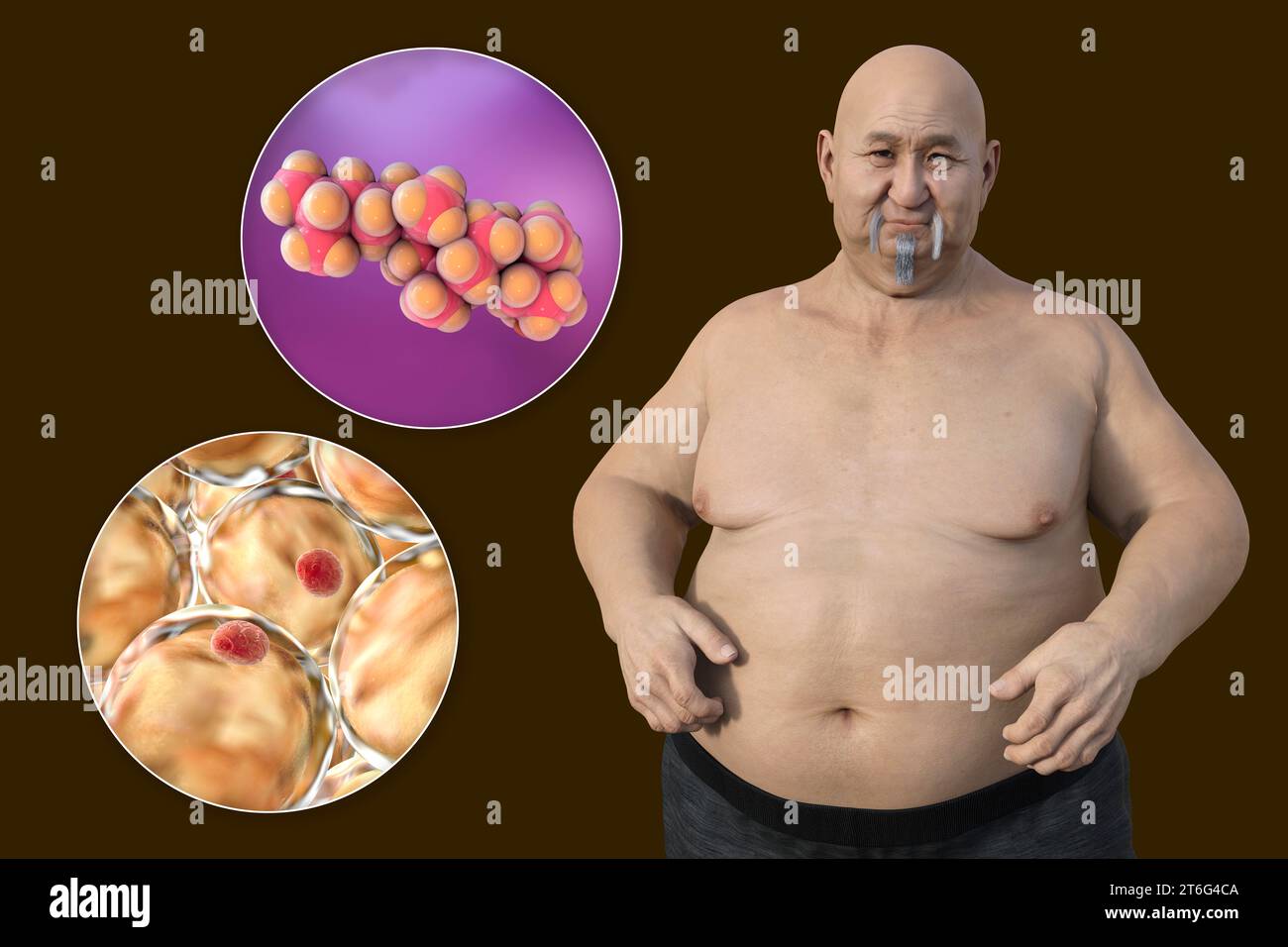 A 3D medical illustration featuring an overweight man with a close-up ...