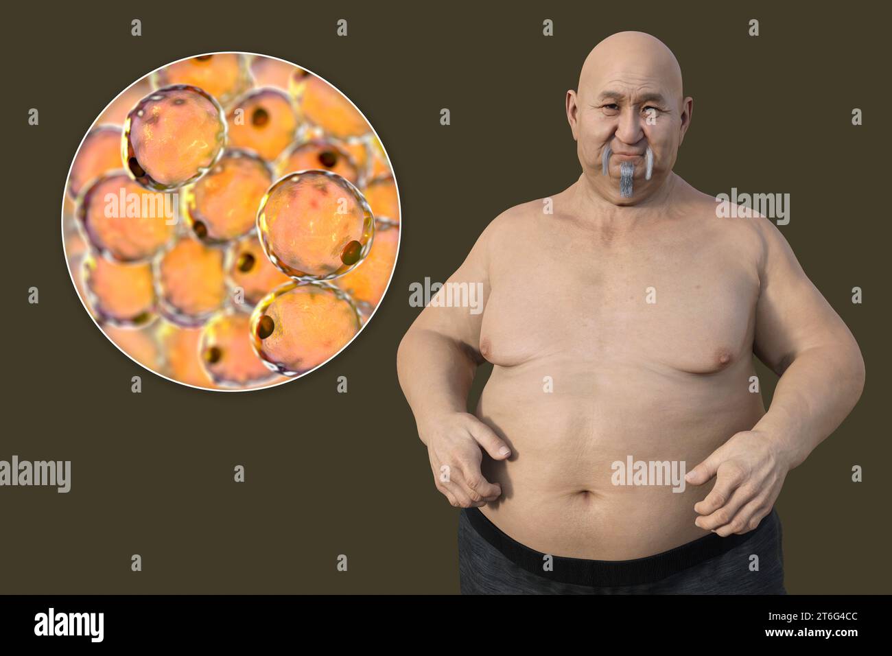 A 3d Medical Illustration Depicting An Overweight Man With A Close Up View Of Adipocytes