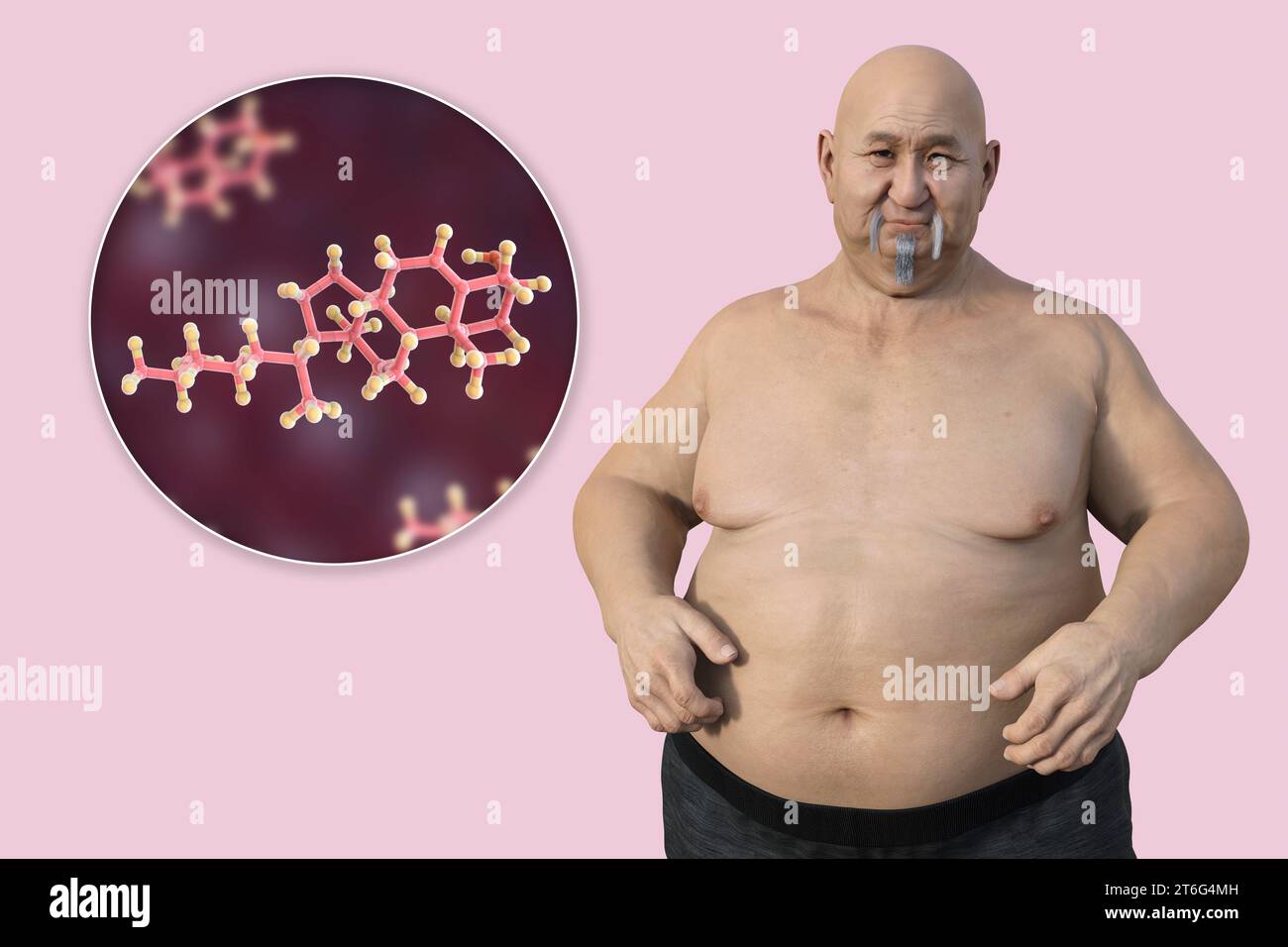 A 3D medical illustration featuring an overweight man with a close-up ...