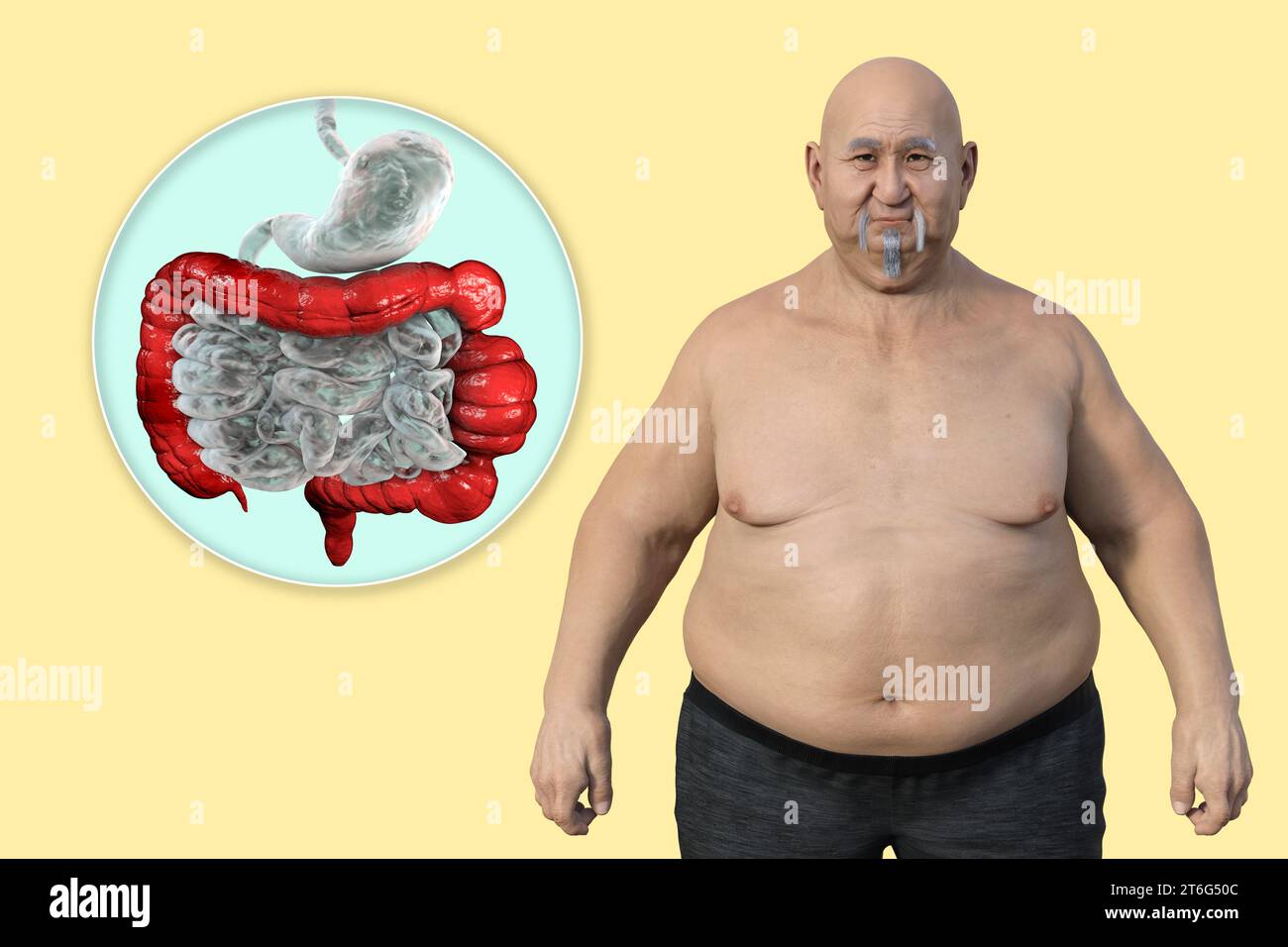 An overweight man, and close-up view of his digestive system ...