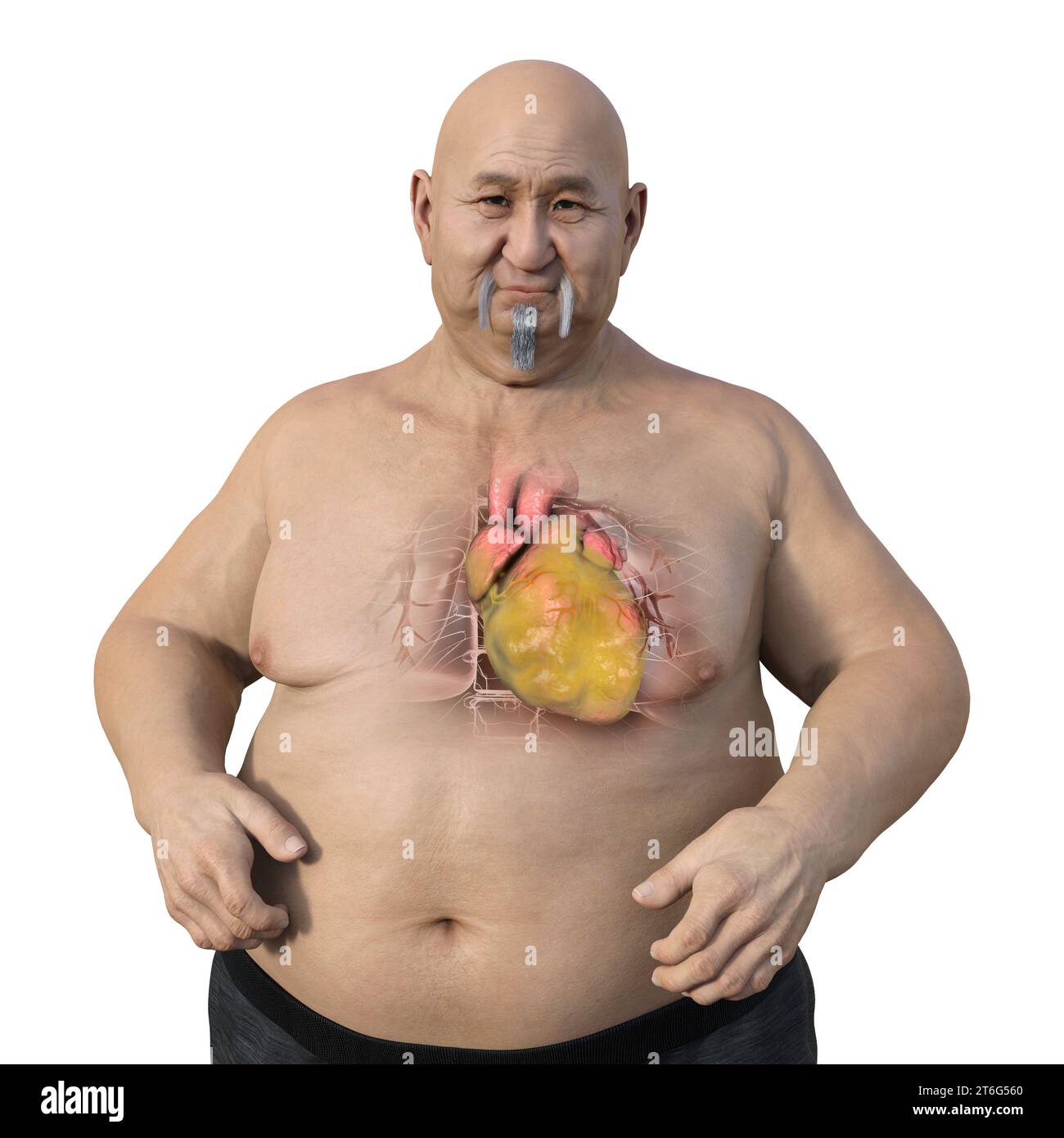 A 3D medical illustration of an overweight man with transparent skin, showcasing an enlarged and ...