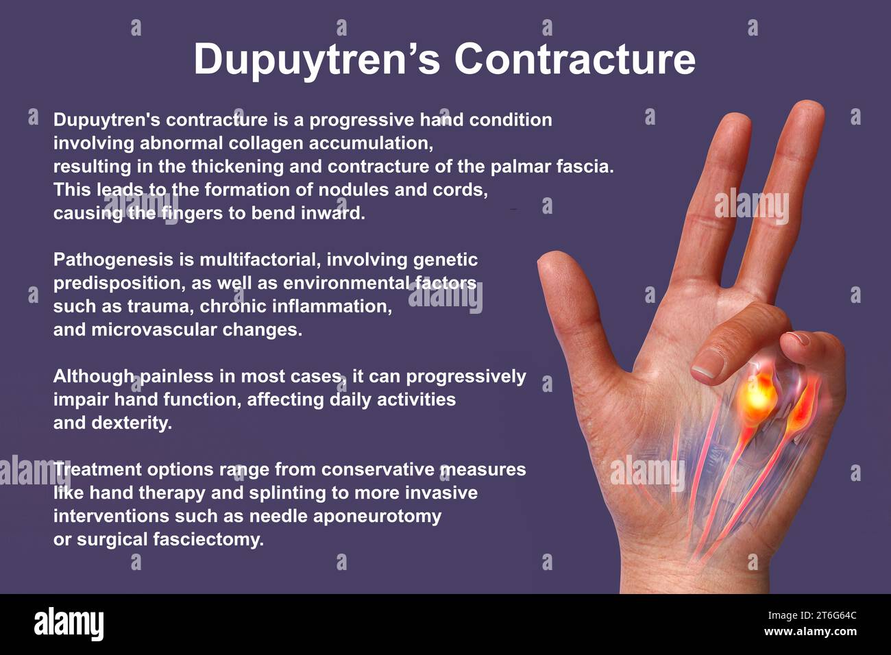 A 3D medical illustration displaying a patient's hand with Dupuytren's ...