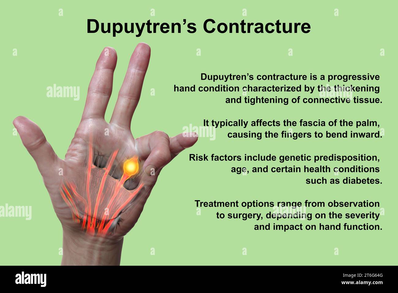 A 3D medical illustration displaying a patient's hand with Dupuytren's ...